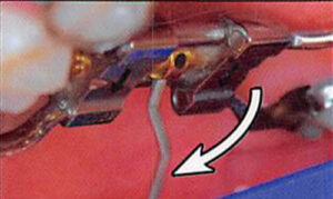 How to turn an expander - Brush n Brace - San Diego Teen Dentist ...