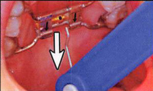 How to turn an expander - Brush n Brace - San Diego Teen Dentist ...